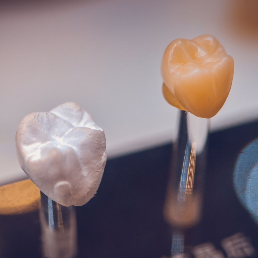 Couronne dentaire Lyon – Céramique esthétique